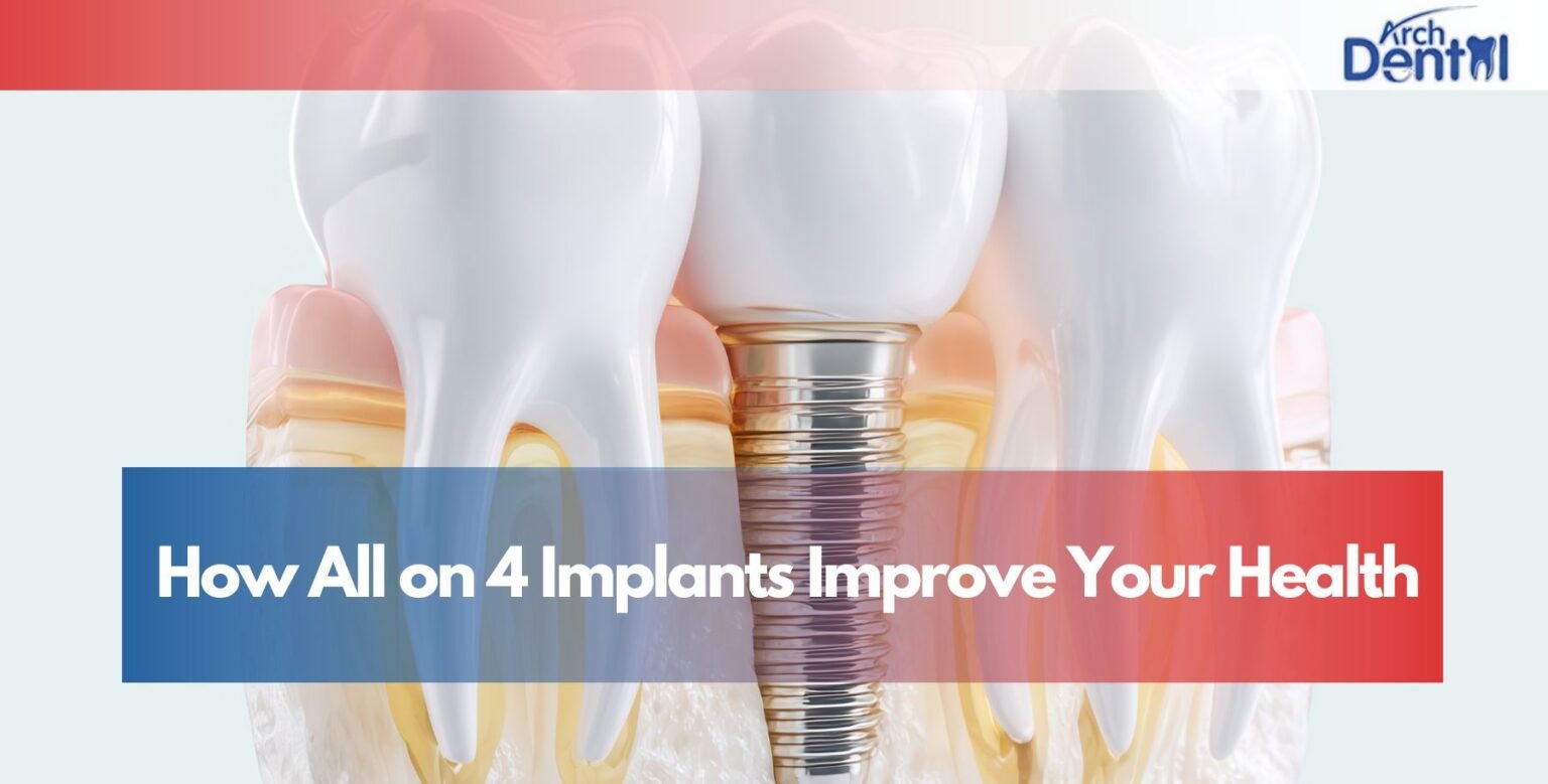How All on 4 Implants Improve Your Health | Arch Dental