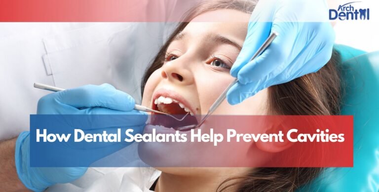 How Dental Sealants Help Prevent Cavities | Arch Dental