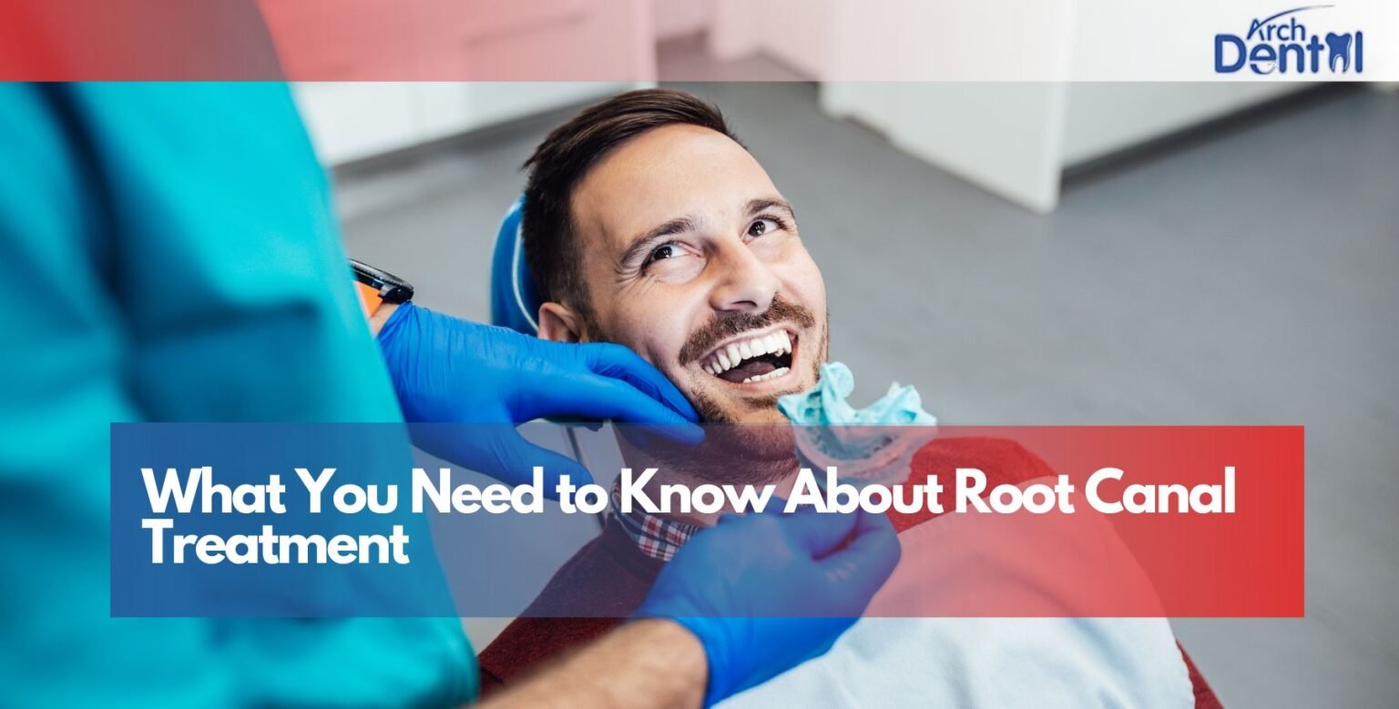 What You Need to Know About Root Canal Treatment | Arch Dental