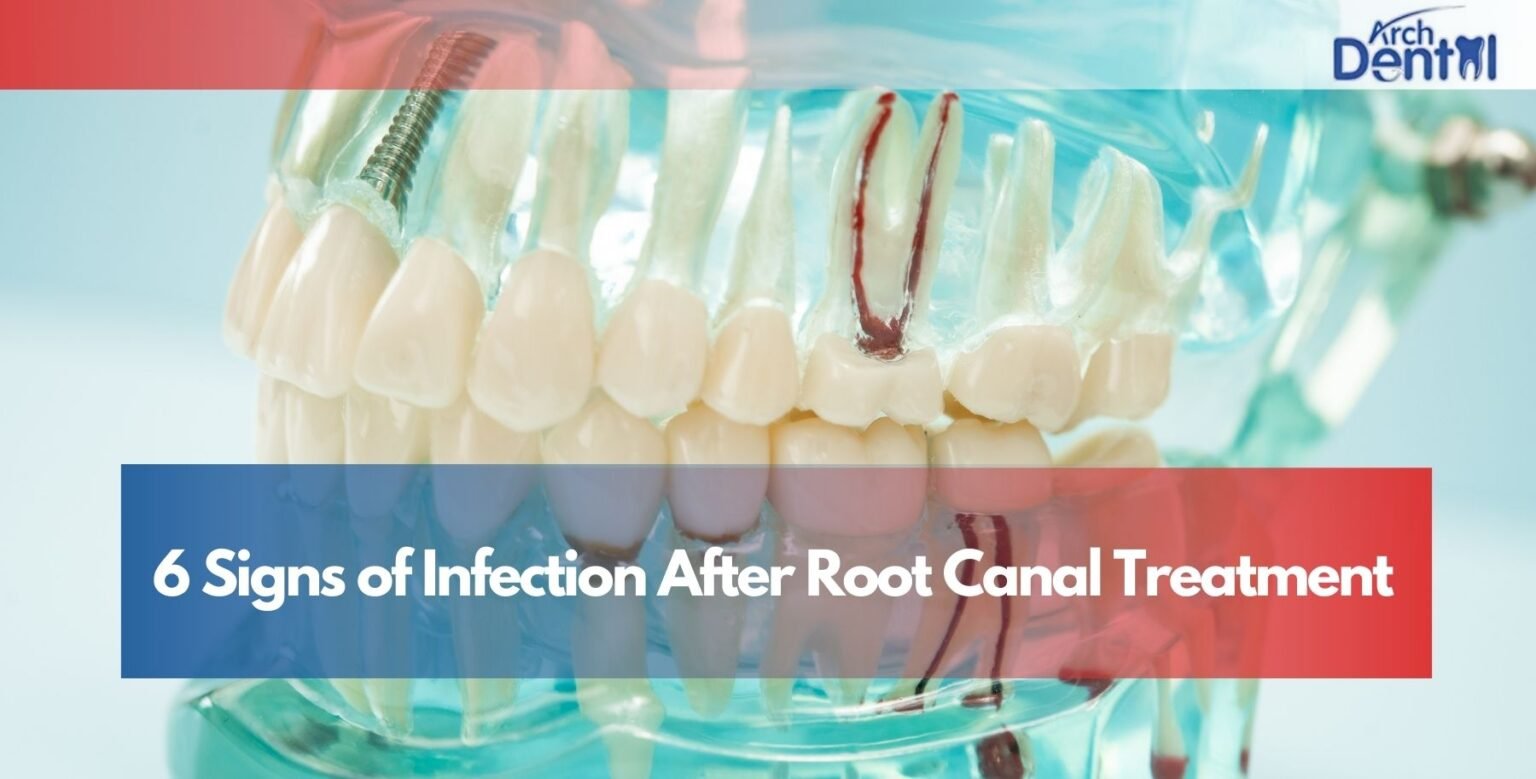 6 Signs of Infection After Root Canal Treatment | Arch Dental