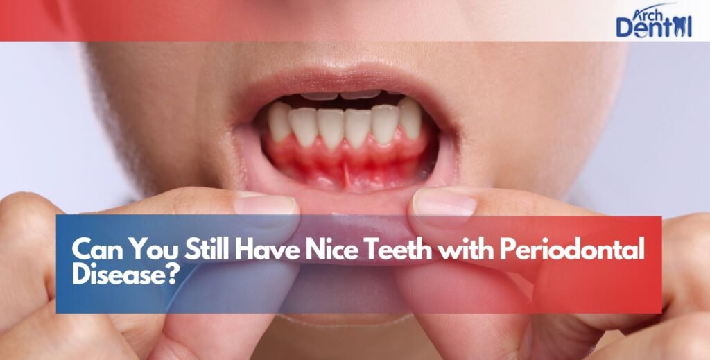 Can You Still Have Nice Teeth with Periodontal Disease | Arch Dental