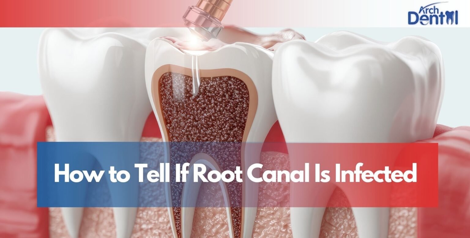How to Tell If Root Canal Is Infected | Arch Dental